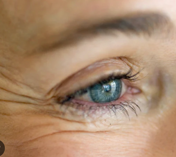 How To Target Deep Lines Aroud The Eyes (at any age) – Skin Beautiful MD